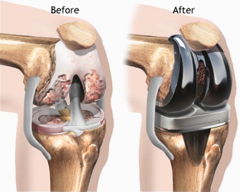 Knee Replacement Surgery Cost: Other alternative treatment options - medagg
